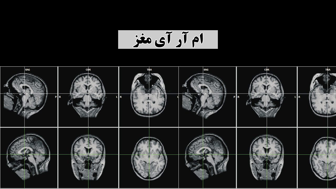 ام آر آی مغز (صفر تا 100 نکات و راهنمایی ها)